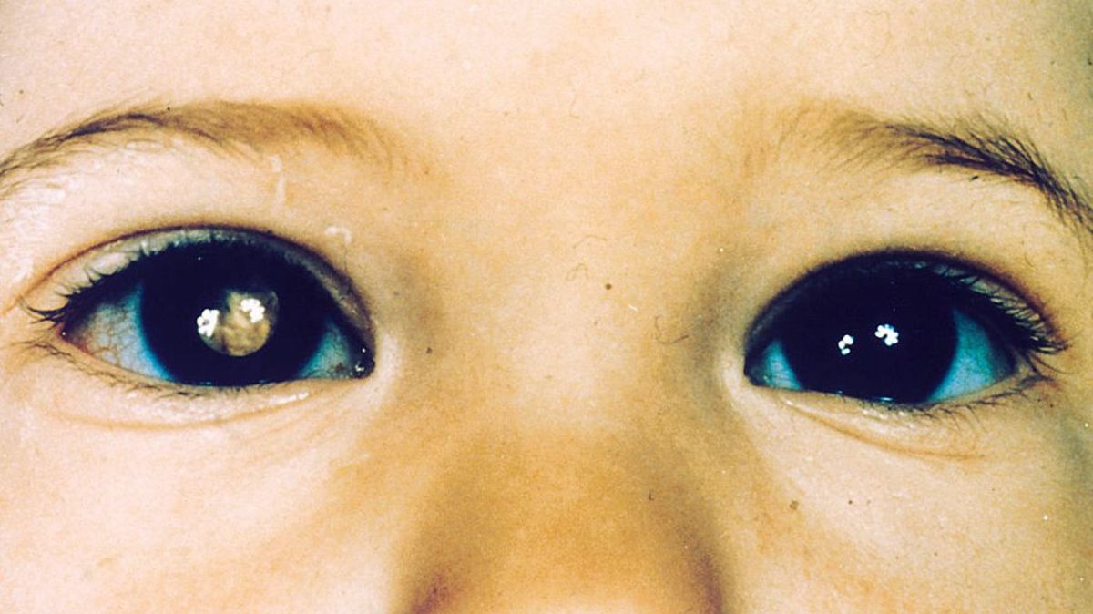 A Baby's Life Was Saved After Flash Photography Detected Signs Of Eye ... A Baby's Life Was Saved After Flash Photography Detected Signs Of Eye ...