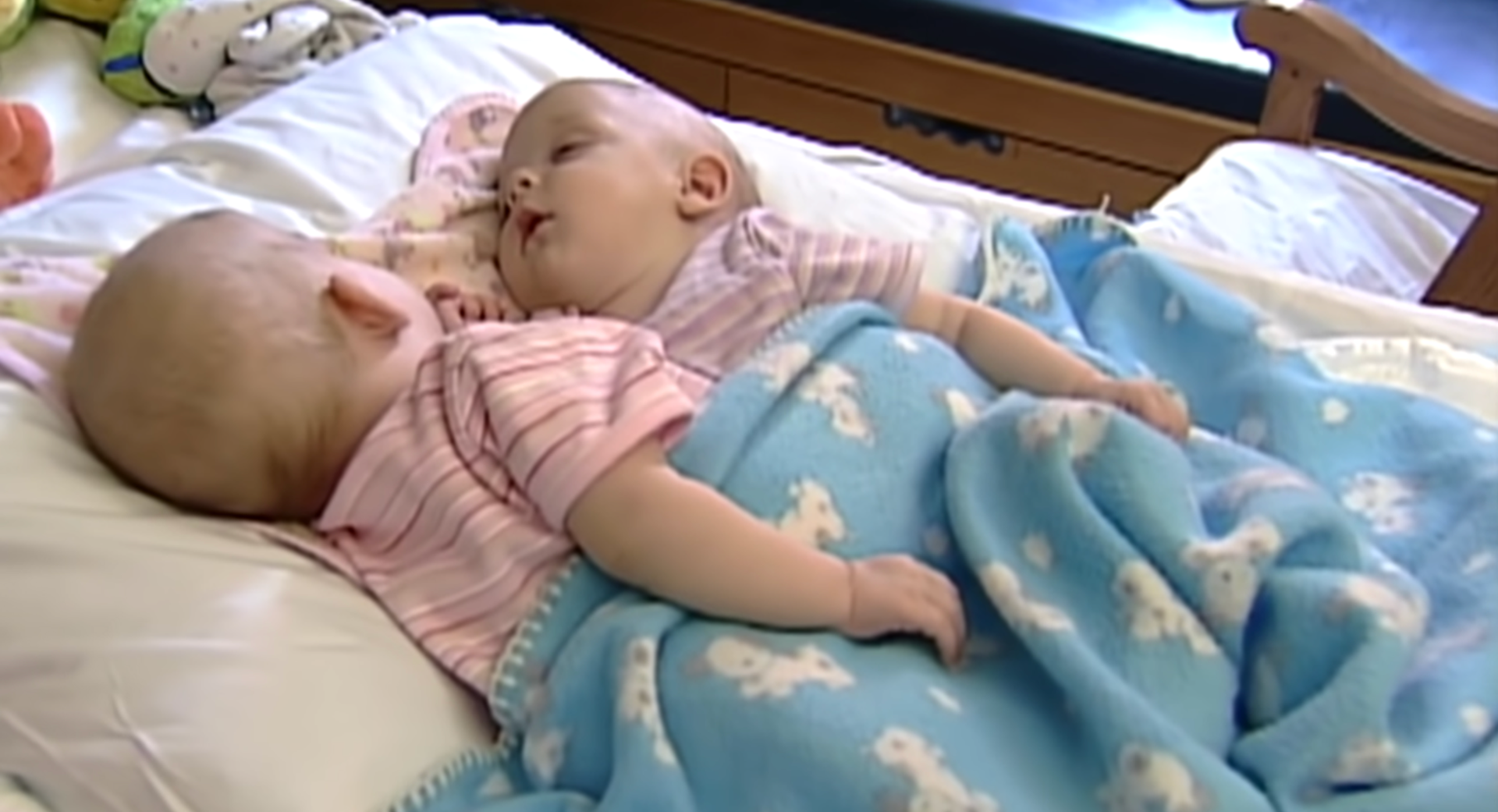 Over A Decade Ago Conjoined Twins Were Separated Through Surgery, Now ...