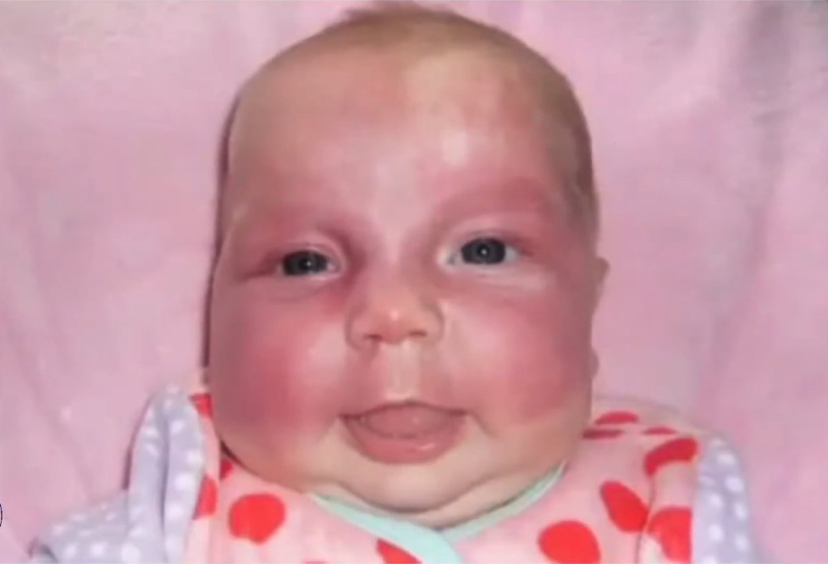 Little Girl Born Covered In 'Polka Dots', Then Doctors Discover The ...