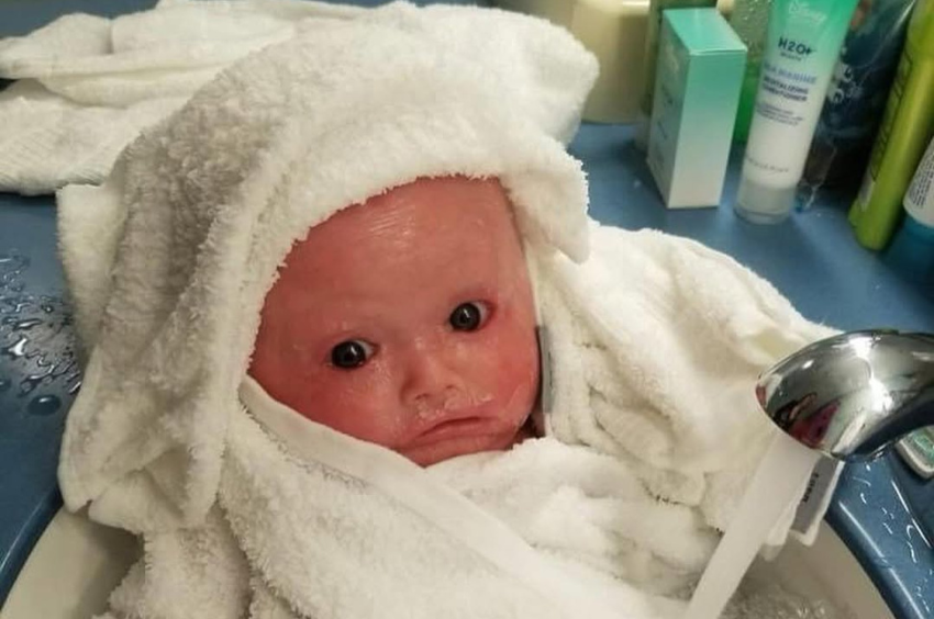 Everyone Was Stunned When This Baby Was Born, But Here's How She Looks ...