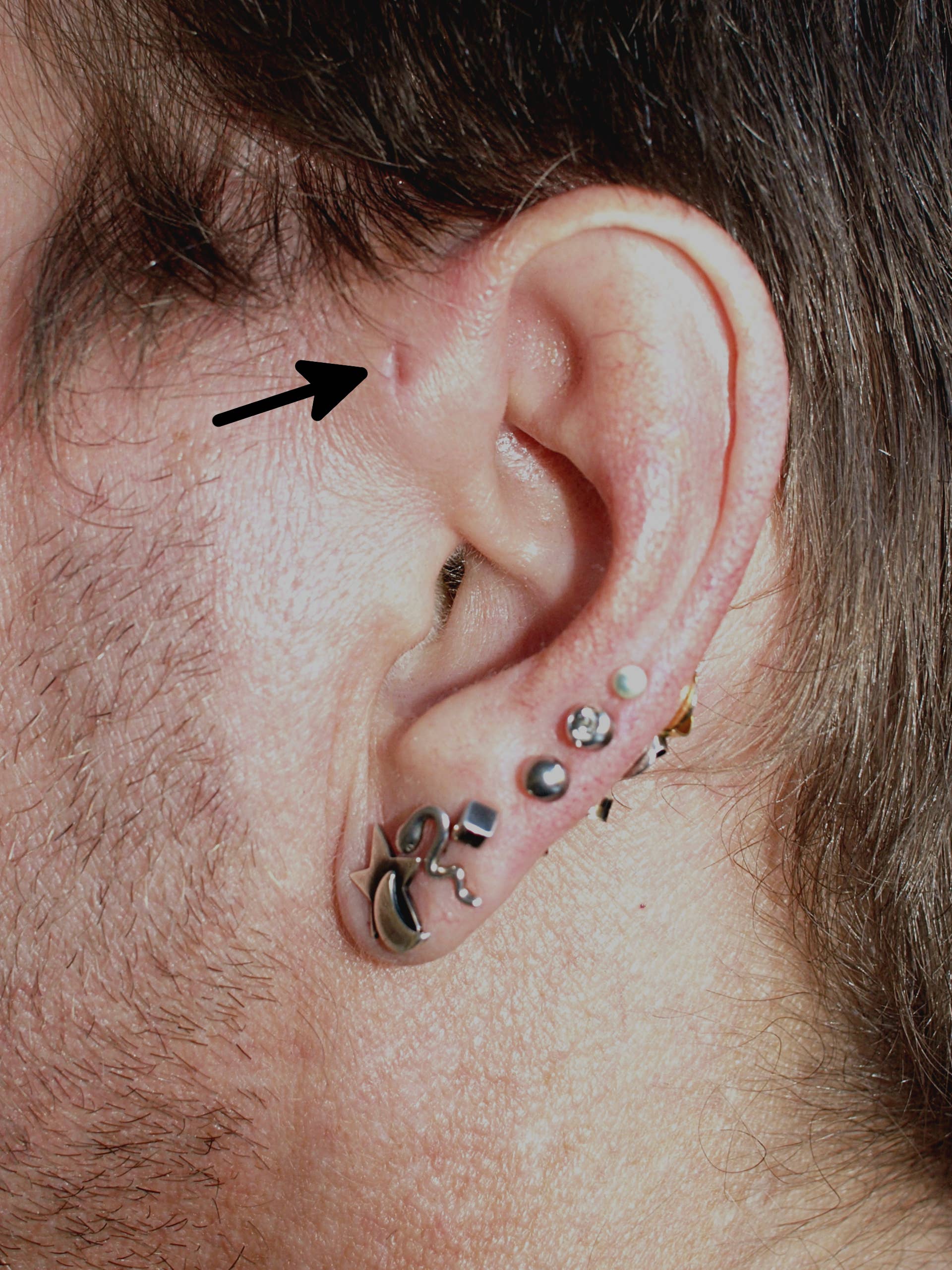 Here's Why Some People Have This Tiny Hole Above Their Ear - Opposing Views
